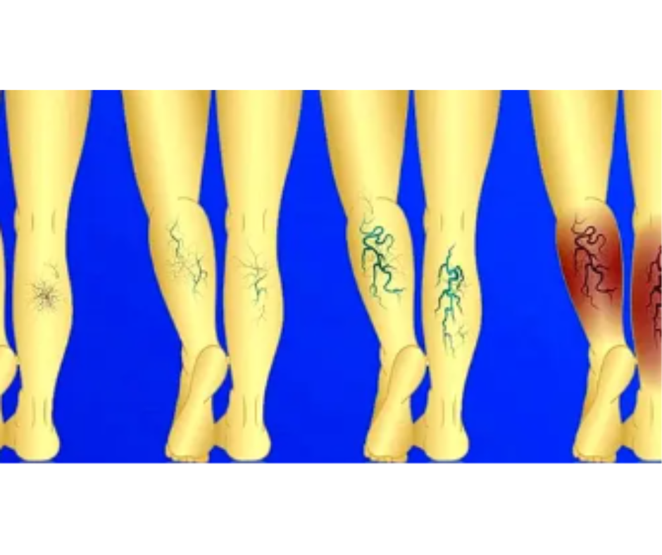 Proširene vene nestaju preko noći! Isprobajte ovo! - Liječi Prirodno